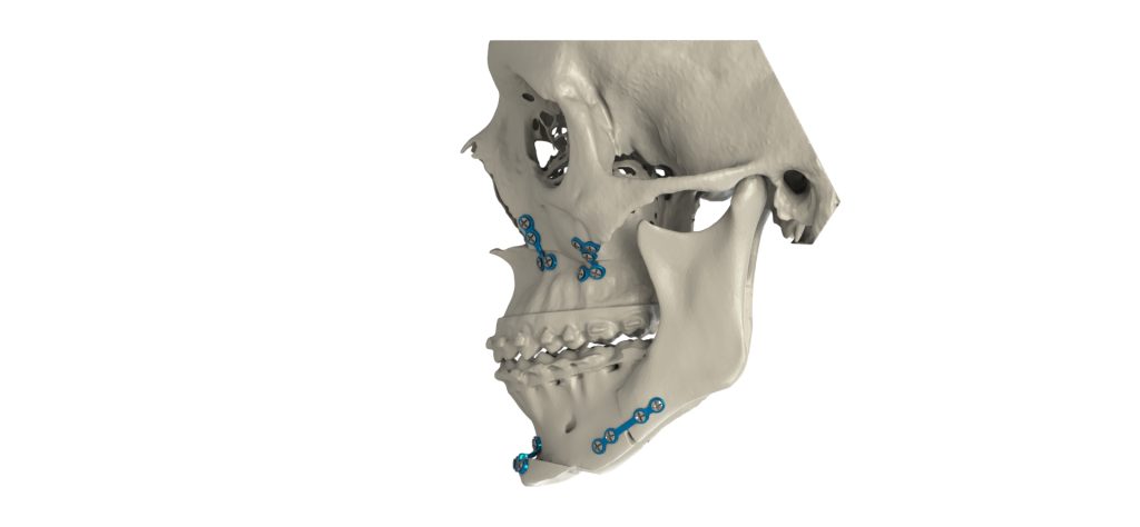 Orthognathic Surgery - Lyka Smith